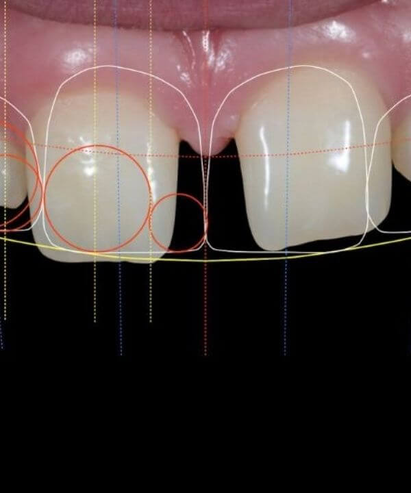 Teeth Whitening – Balikesir, Türkiye | Noticeably Whiter Smile in One ...